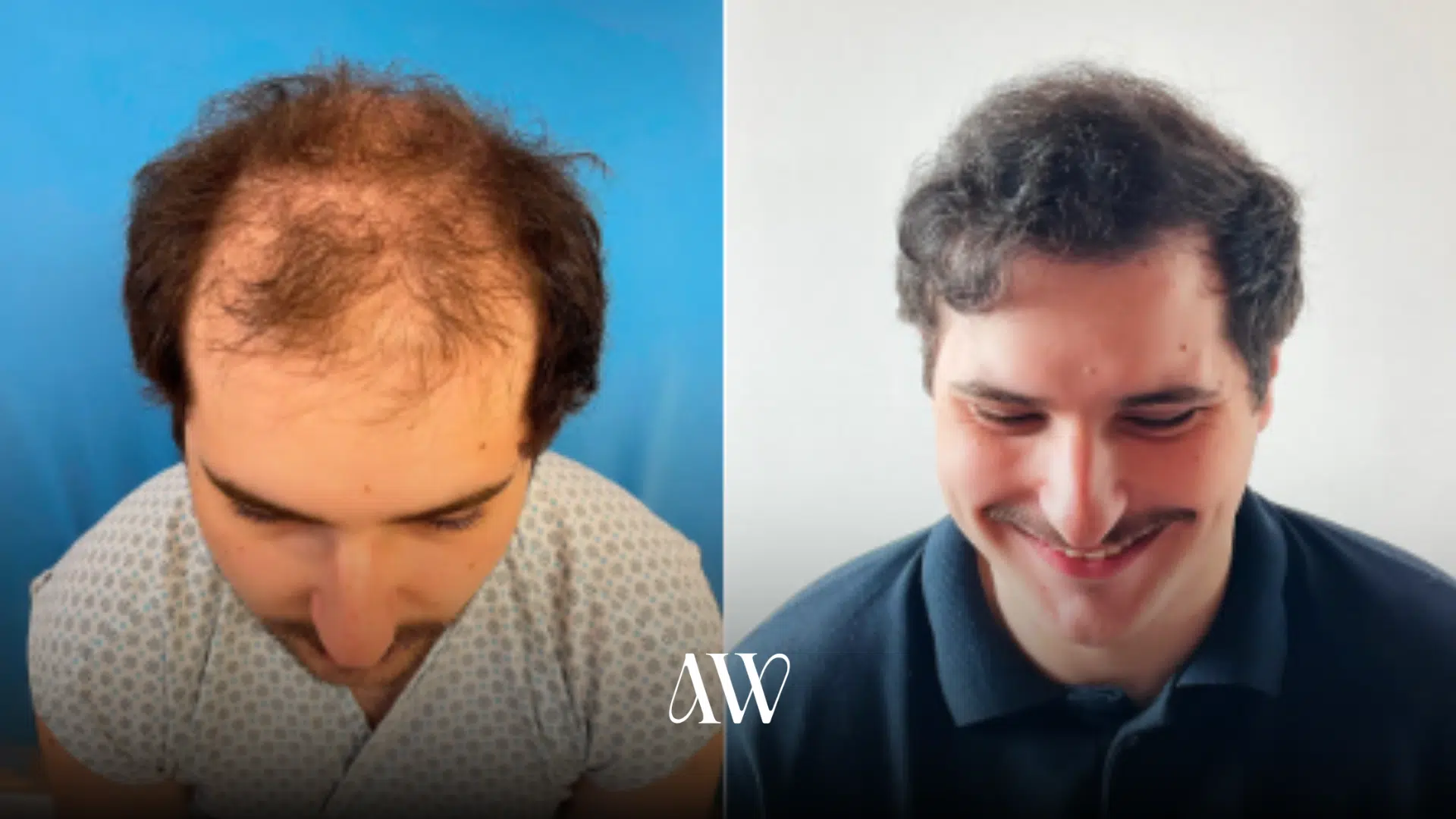 Transplante capilar sem raspar: discrição com Dr. Alan Wells